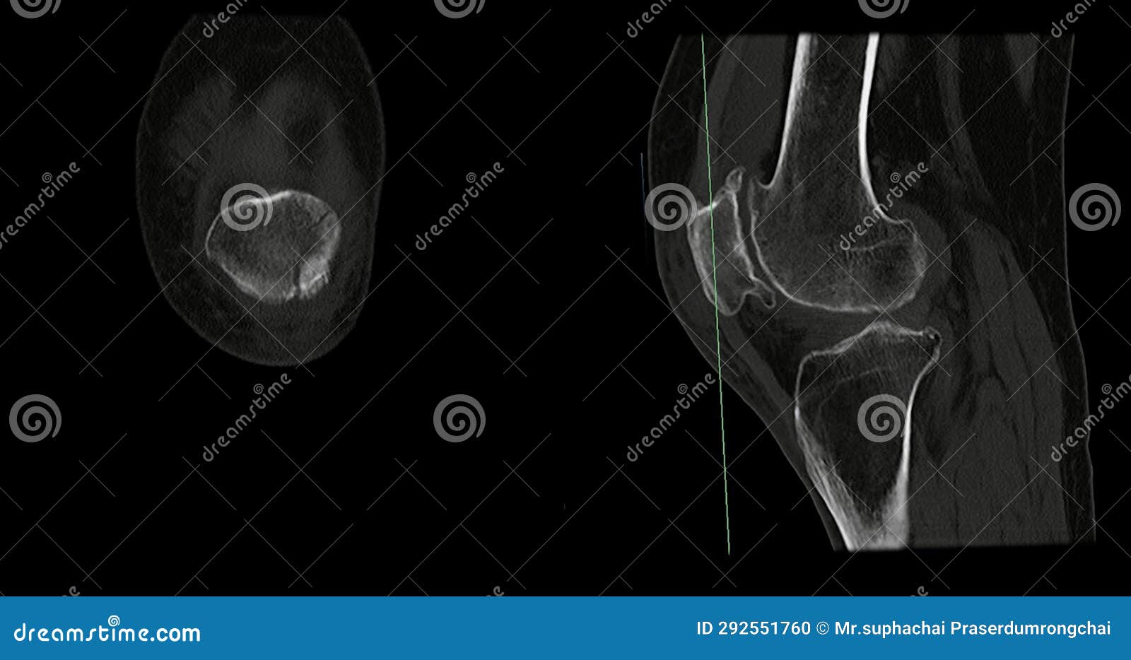 CT Scan of Knee Joint Sagittal and Coronal in Case Fracture Patella Bone Stock Illustration ...