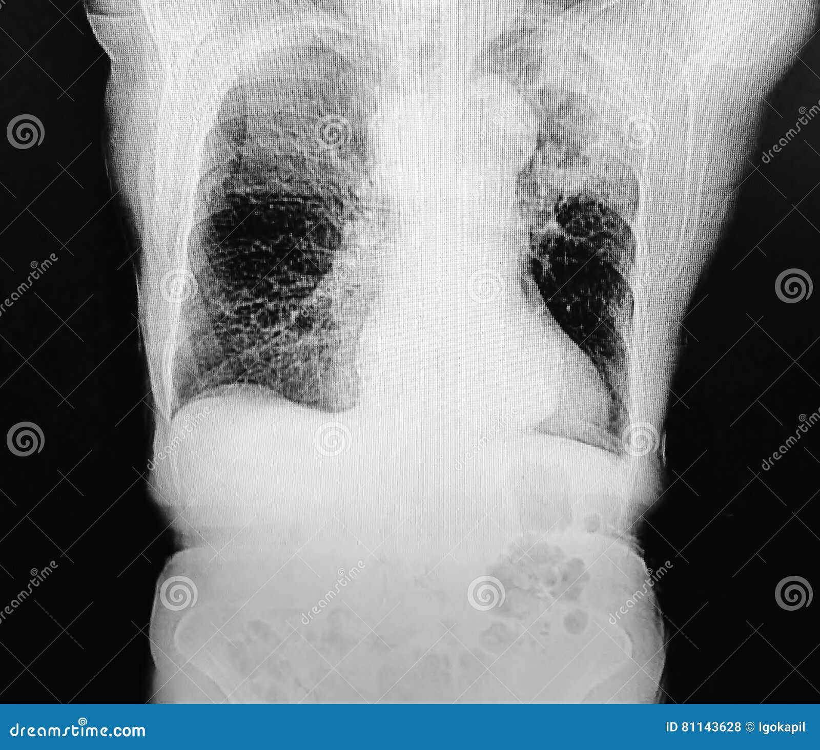 Ct Scan Lung Cavitary Mass Malignancy Stock Photo - Image of diagnosis ...