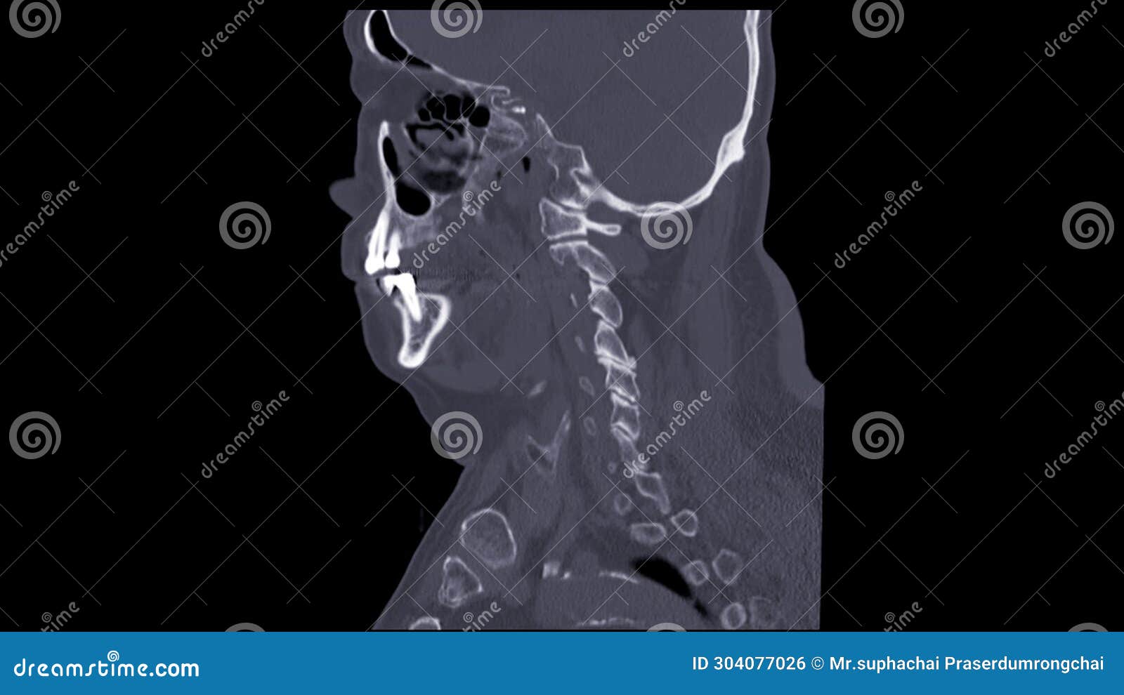 A CT Scan of the Neck Sagittal View for Diagnostic Technique is ...