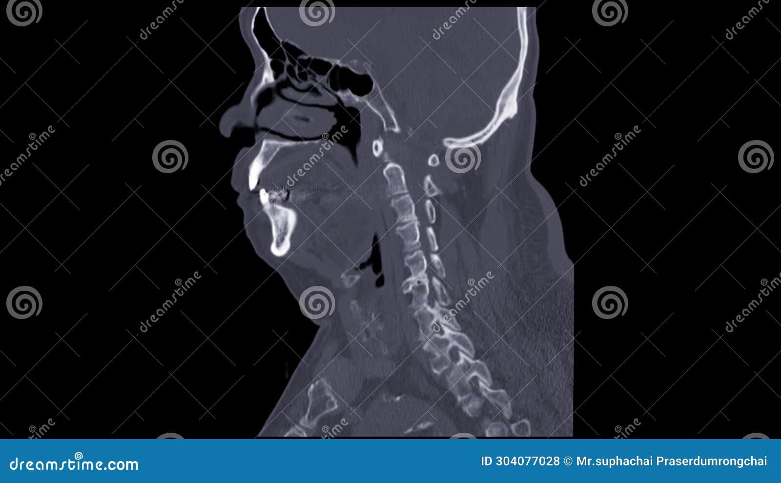 A CT Scan of the Neck Sagittal View for Diagnostic Technique is ...