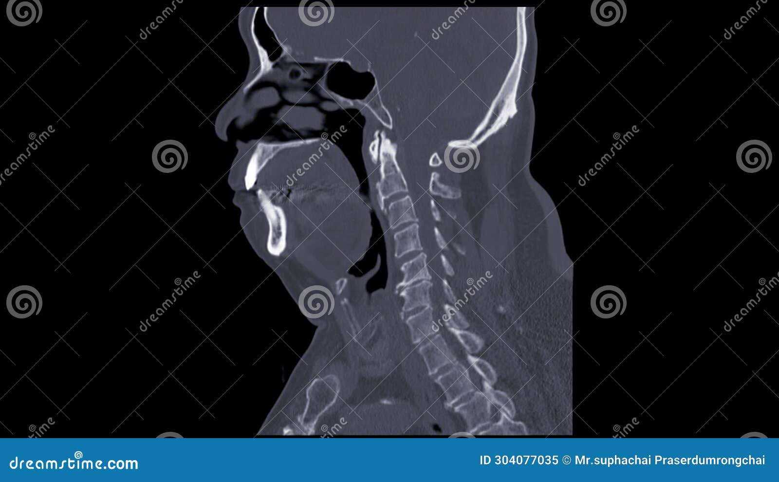 A CT Scan of the Neck Sagittal View for Diagnostic Technique is ...