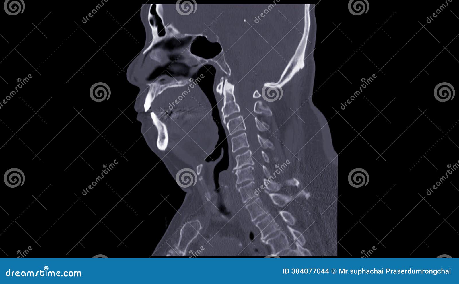 A CT Scan of the Neck Sagittal View for Diagnostic Technique is ...