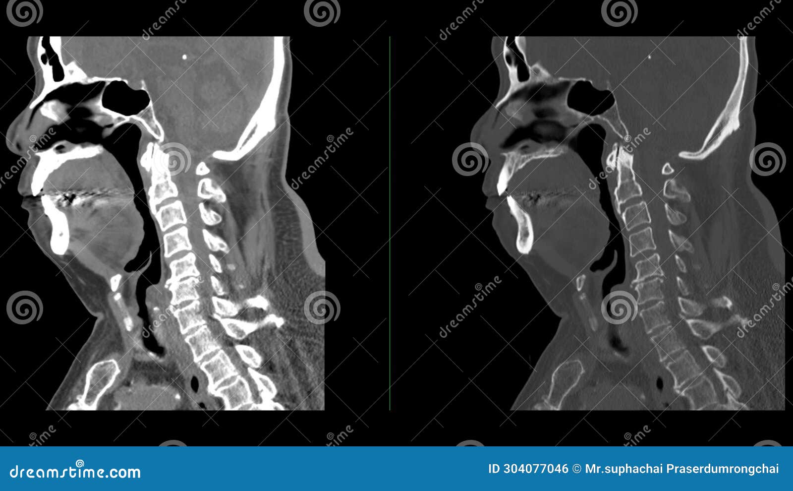 A CT Scan of the Neck Sagittal View for Diagnostic Technique is ...