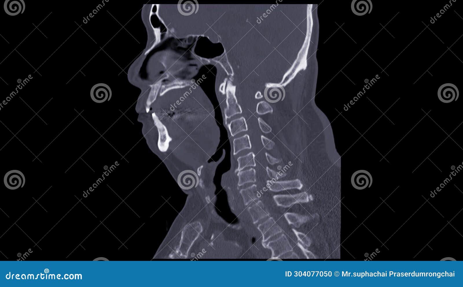 A CT Scan of the Neck Sagittal View for Diagnostic Technique is ...