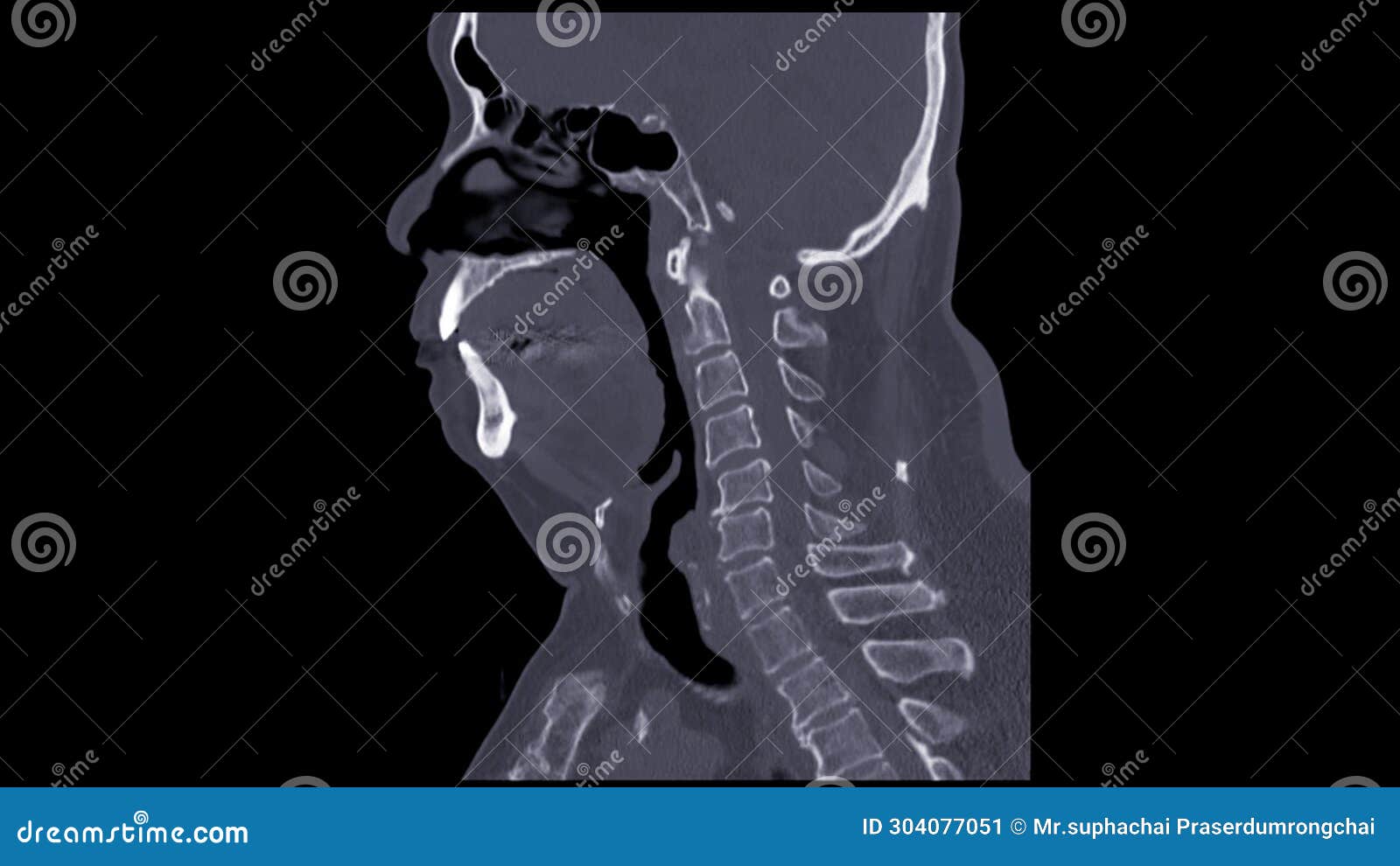 A CT Scan of the Neck Sagittal View for Diagnostic Technique is ...