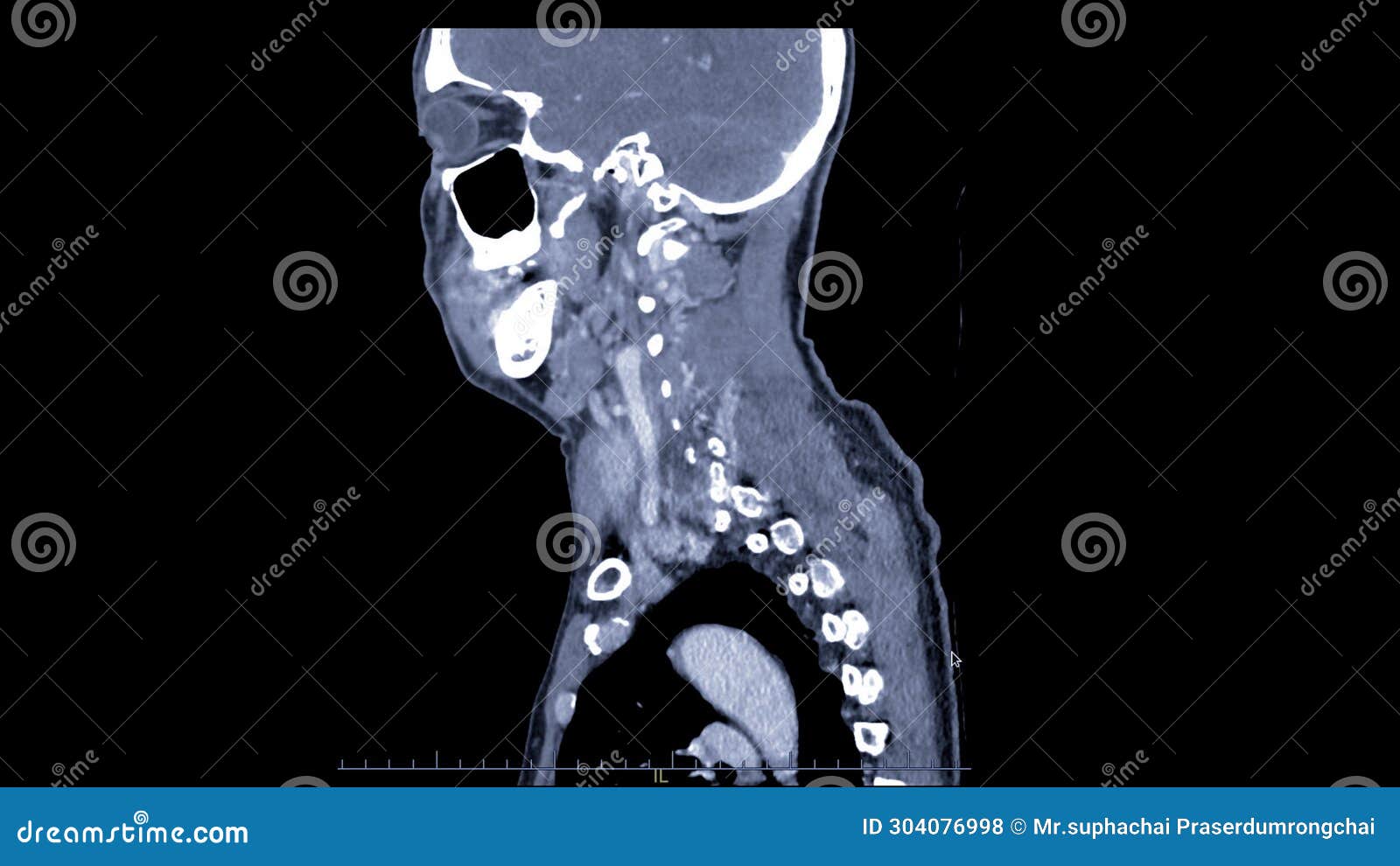 A CT Scan of the Neck Sagittal View for Diagnostic Technique is ...