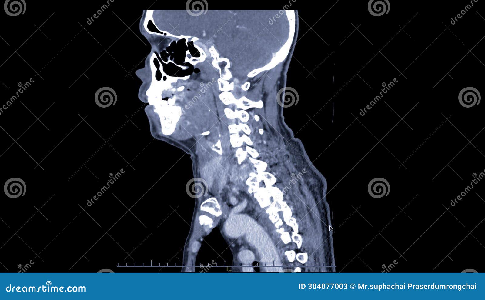 A CT Scan of the Neck Sagittal View for Diagnostic Technique is ...