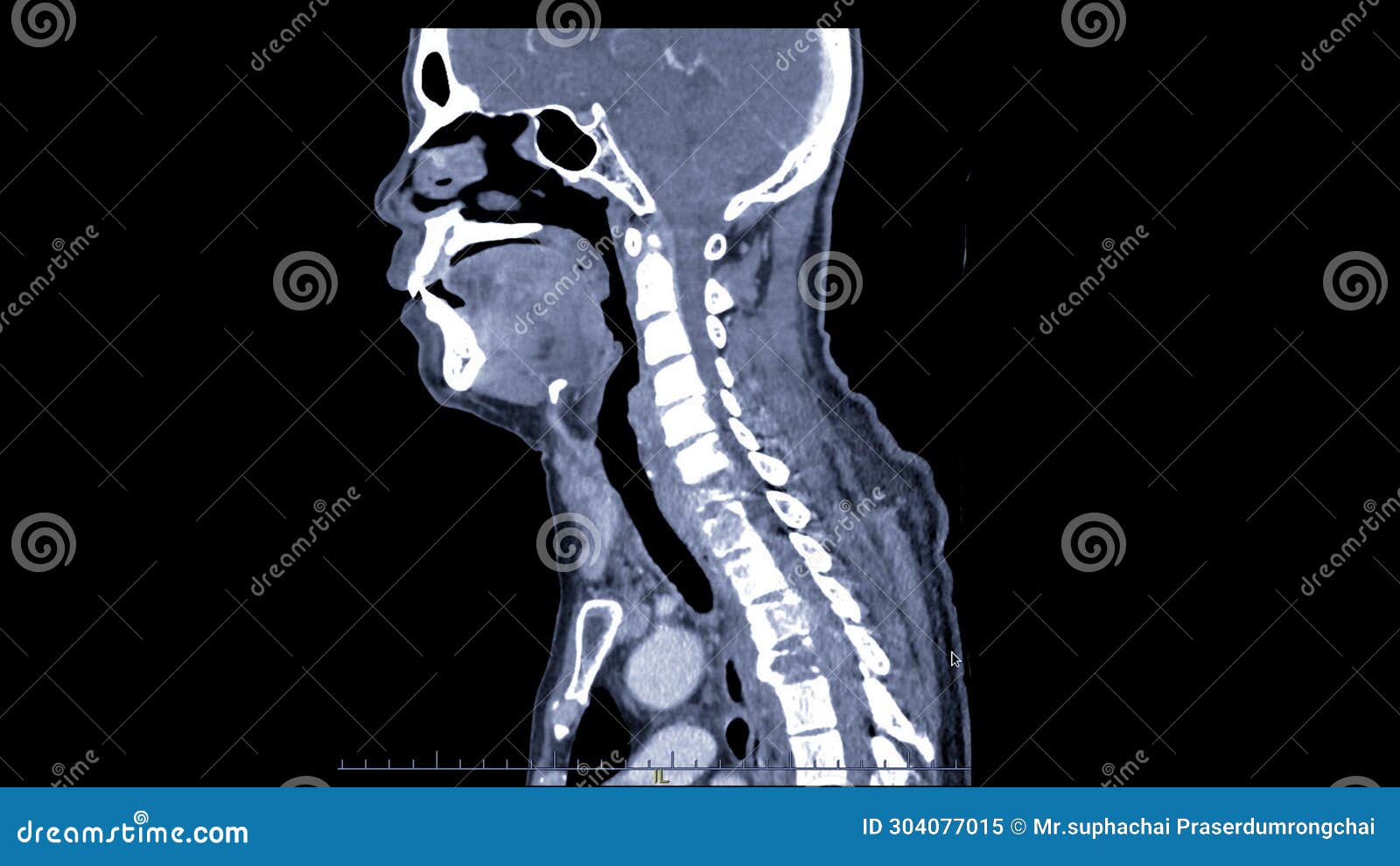 A CT Scan of the Neck Sagittal View for Diagnostic Technique is ...