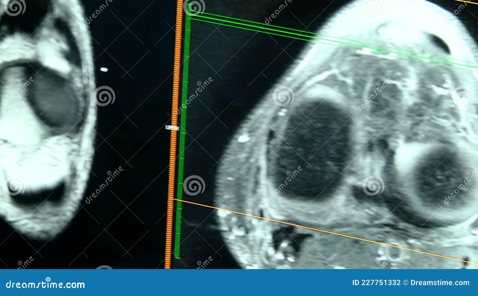 CT Scan of Patient in Dynamic Stock Footage - Video of computer, exam ...