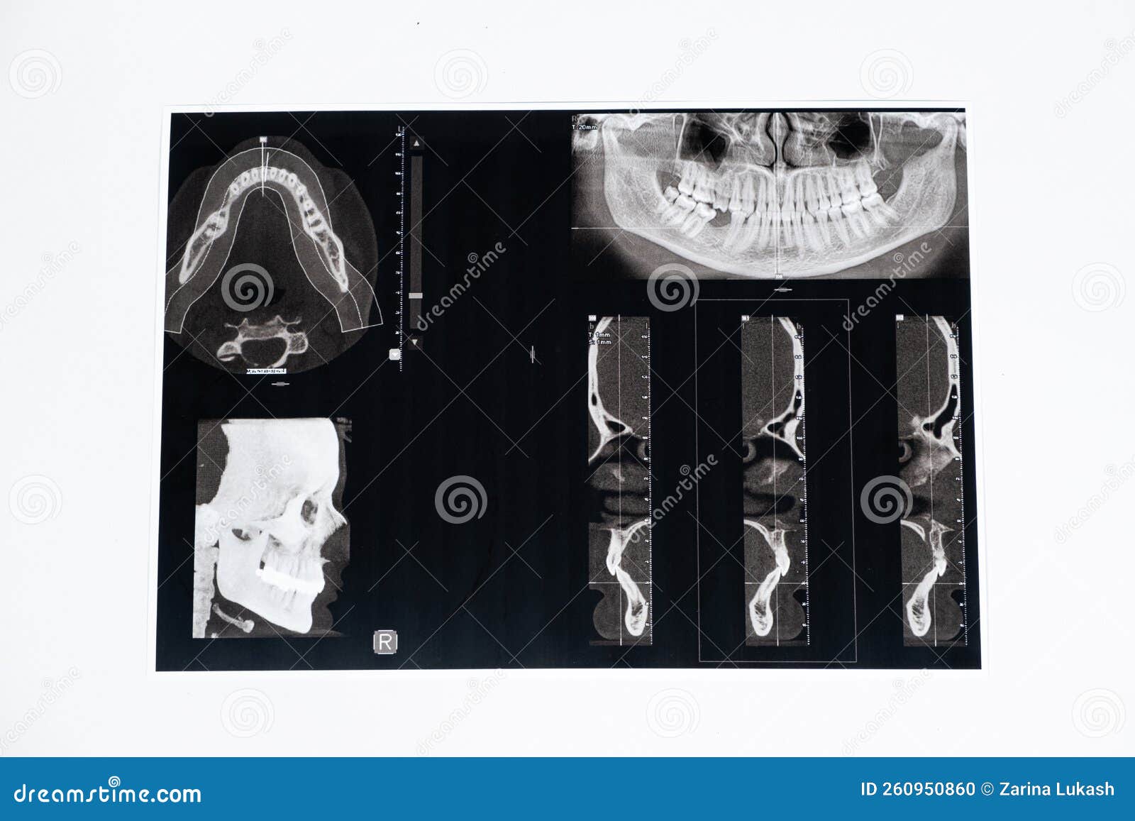 CT Scan of a Patient with Malocclusion, Missing Chewing Tooth and ...