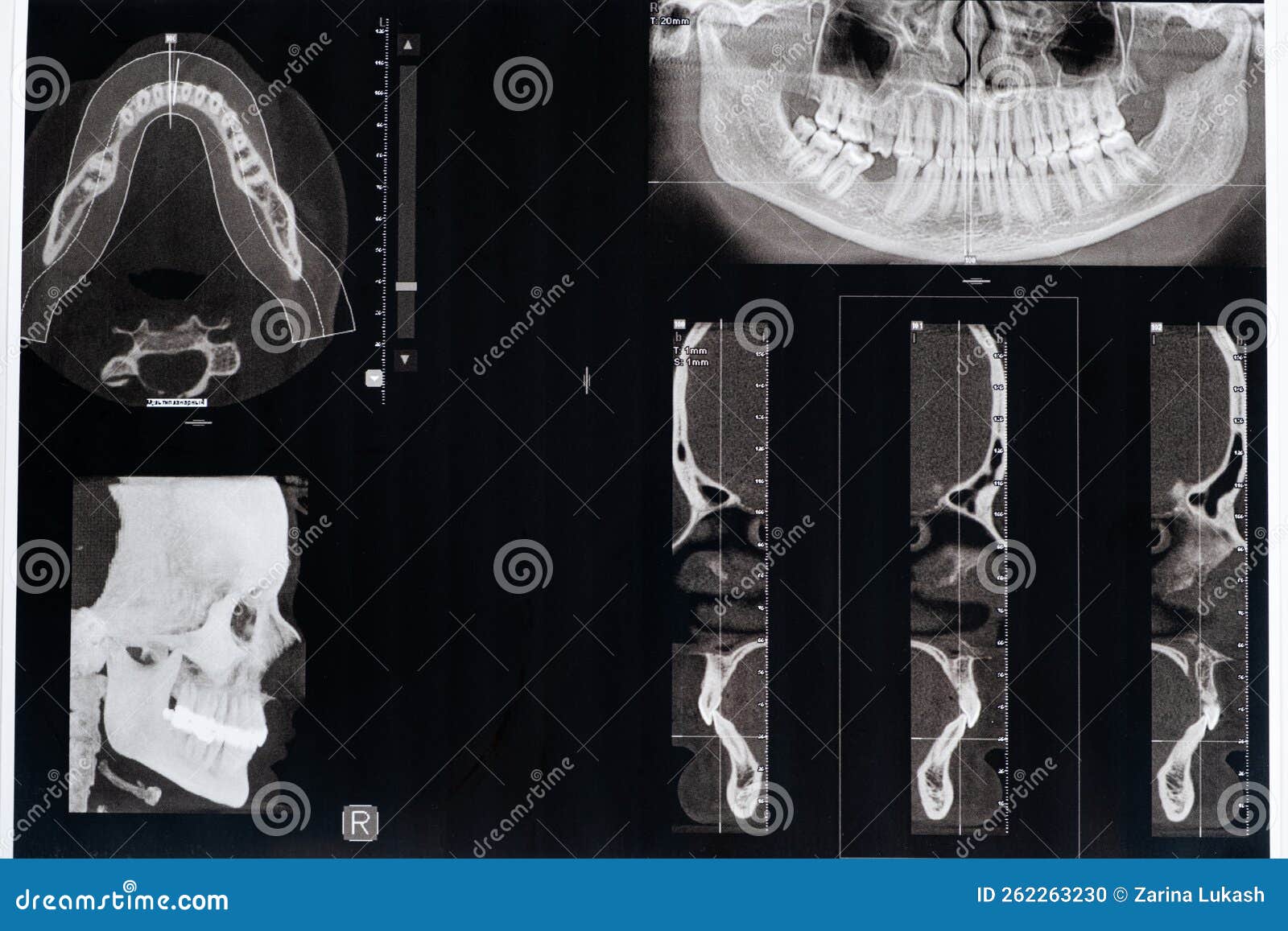 CT Scan of a Patient with Malocclusion, Missing Chewing Tooth and ...