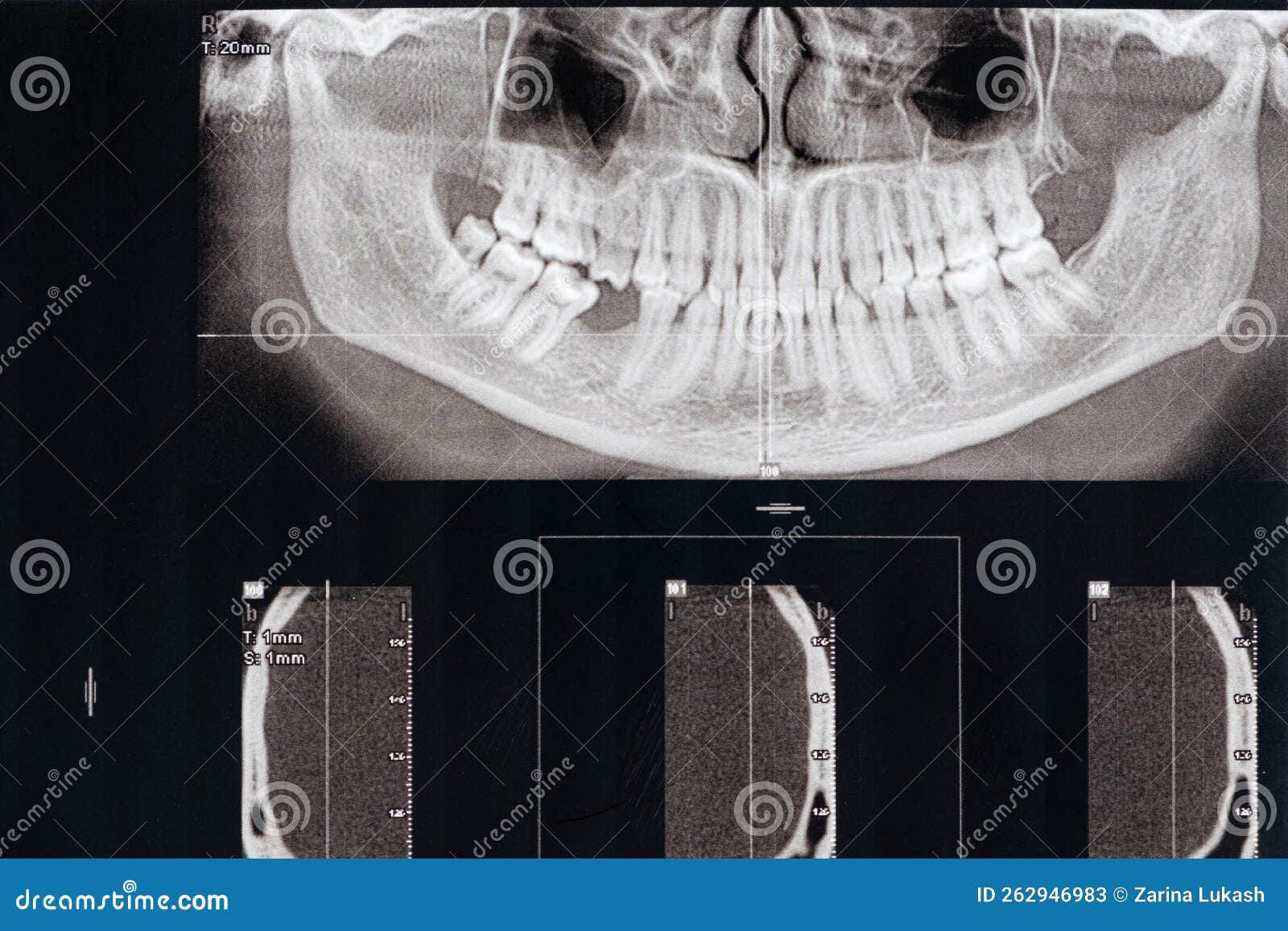 A Patient With Malocclusion, Missing Chewing Tooth And ...