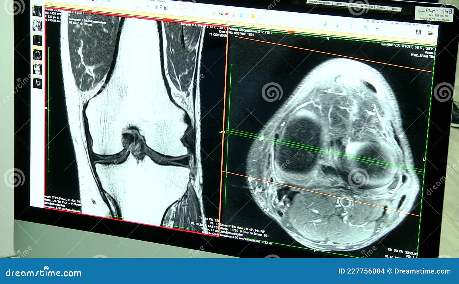 CT Scan of Patient in Dynamic Stock Footage - Video of treatment ...