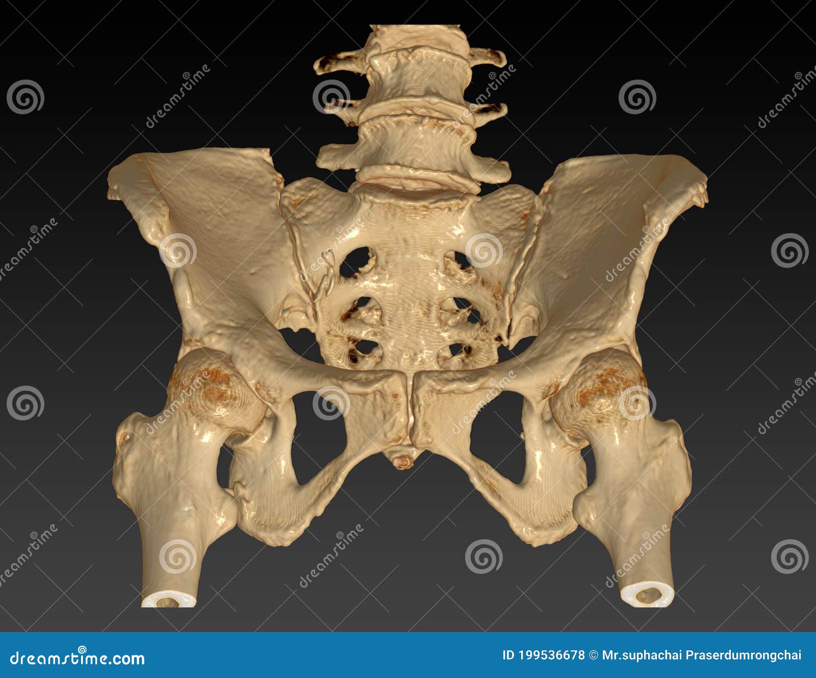 CT Scan Of Pelvic Bone With Both Hip Joint 3D Rendering Image Inlet ...