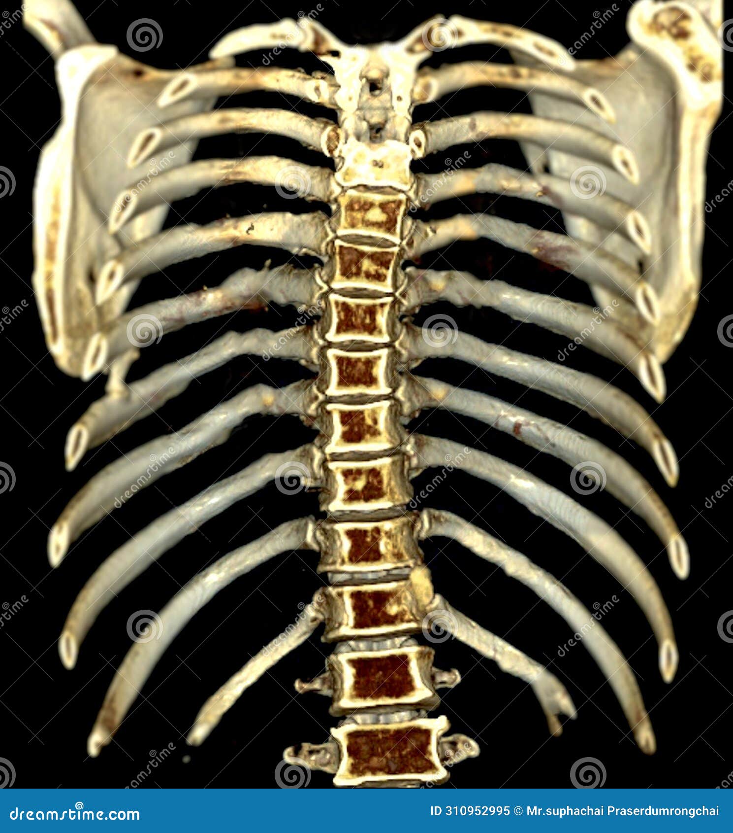 CT Scan Rib 3D Rendering Provides Precise Imaging of Rib Structures ...