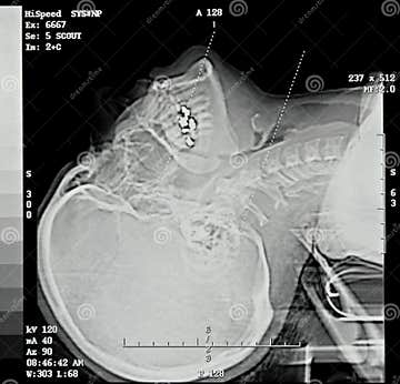 CT Scan Scout 5 stock photo. Image of brain, isolated - 6575776