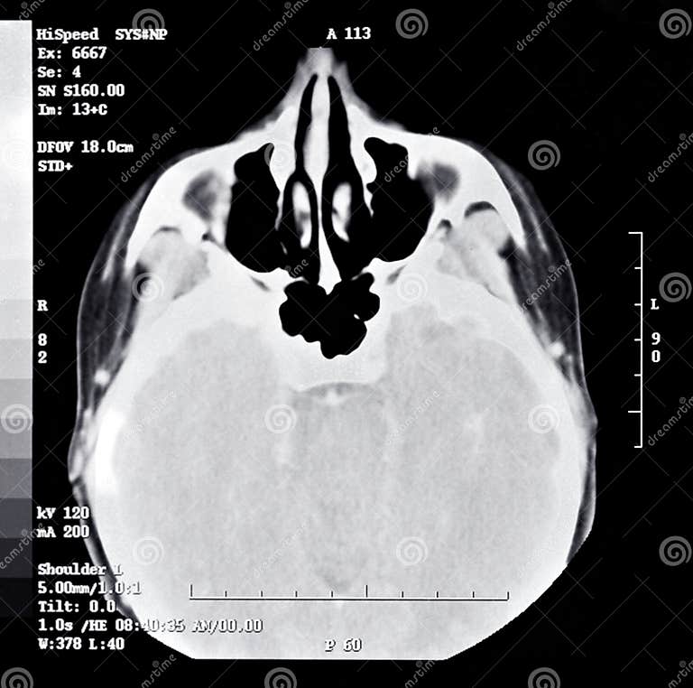CT Scan Segment stock image. Image of bones, black, health - 6545775
