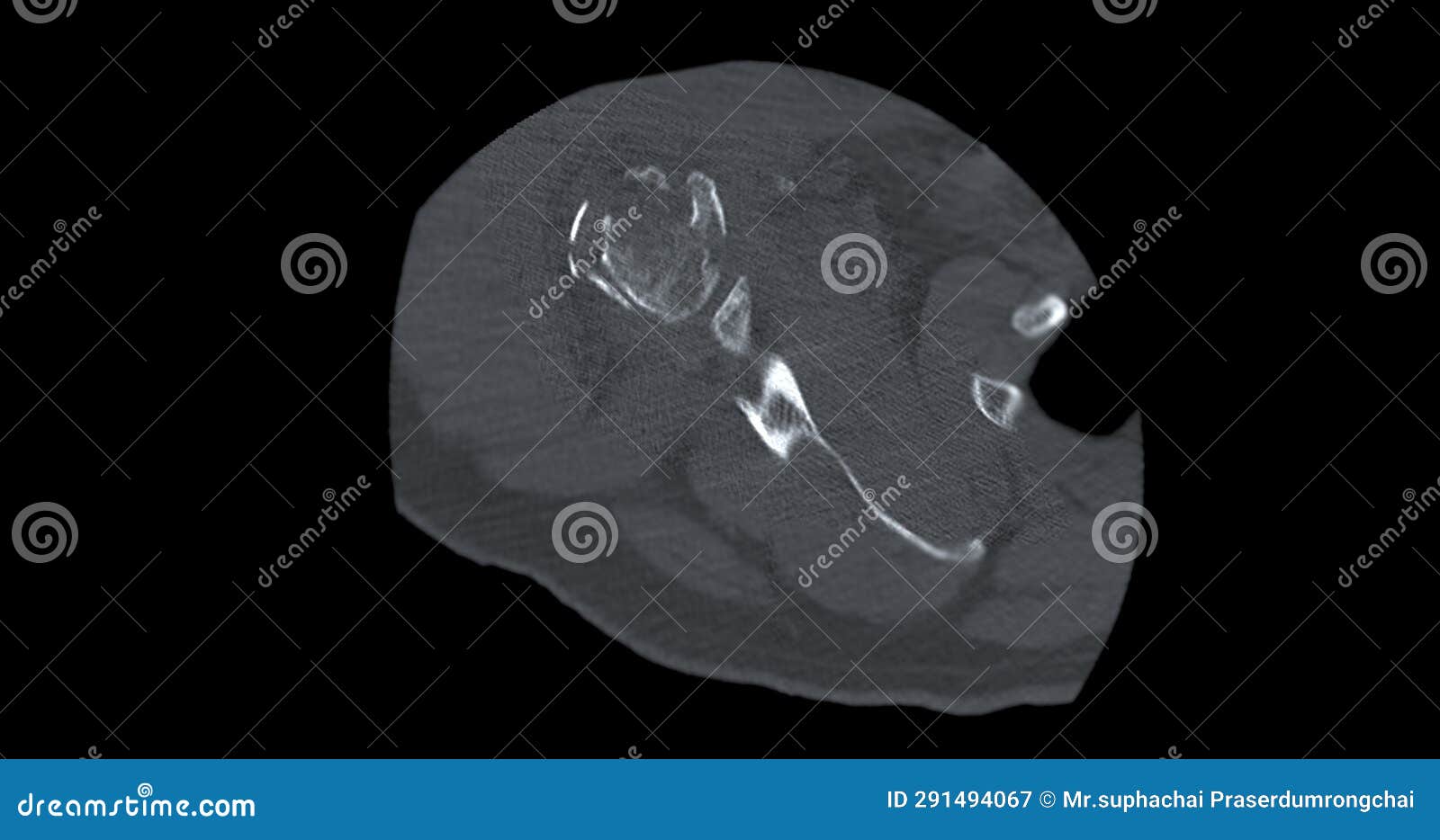 CT Scan of Shoulder Joint in Case Fracture Shoulder Joint Stock Image ...