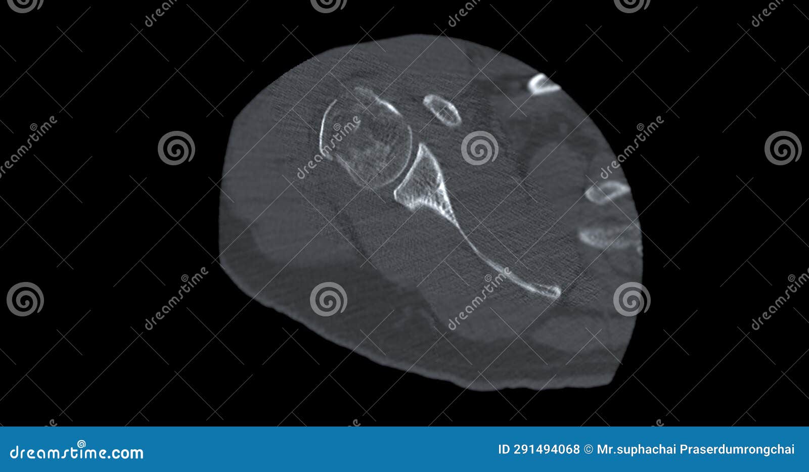 CAT -SCAN Of Rib Fracture Royalty-Free Stock Photography ...