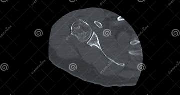 CT Scan of Shoulder Joint in Case Fracture Shoulder Joint Stock Photo ...