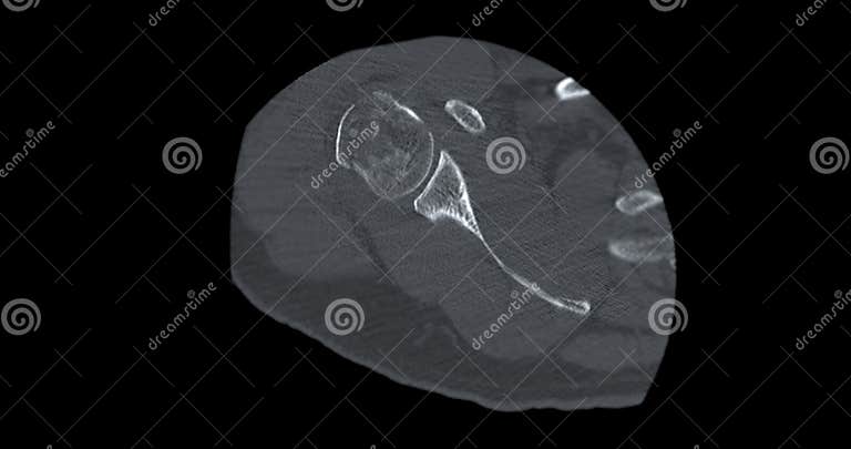 CT Scan of Shoulder Joint in Case Fracture Shoulder Joint Stock Photo ...