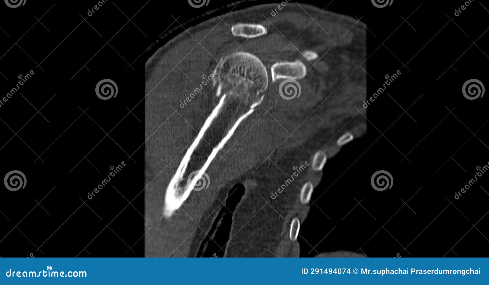 CT Scan of Shoulder Joint in Case Fracture Shoulder Joint Stock Photo ...