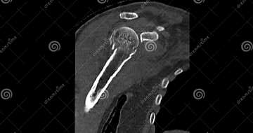 CT Scan of Shoulder Joint in Case Fracture Shoulder Joint Stock Photo ...