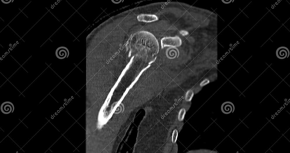 CT Scan of Shoulder Joint in Case Fracture Shoulder Joint Stock Photo ...
