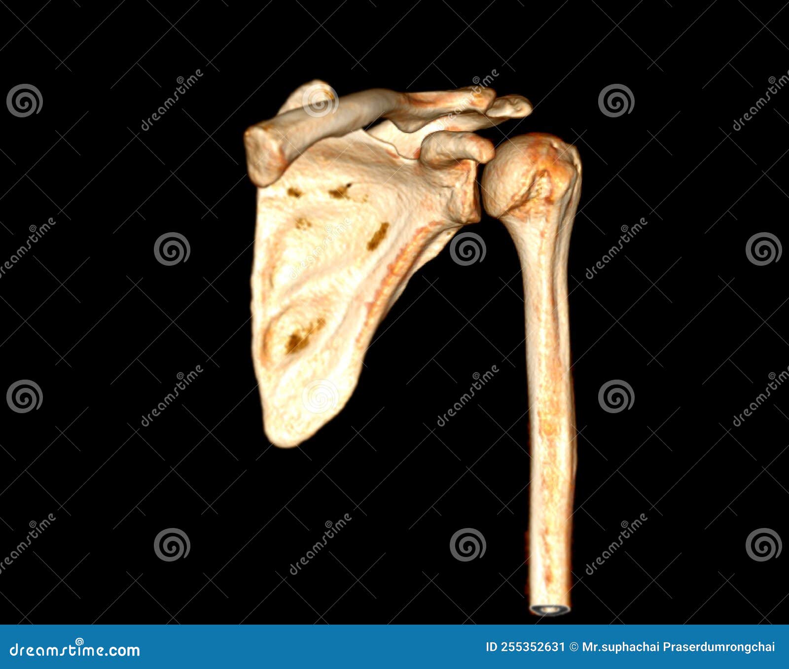 CT Scan Of Shoulder Joint Stock Photography | CartoonDealer.com #255352634