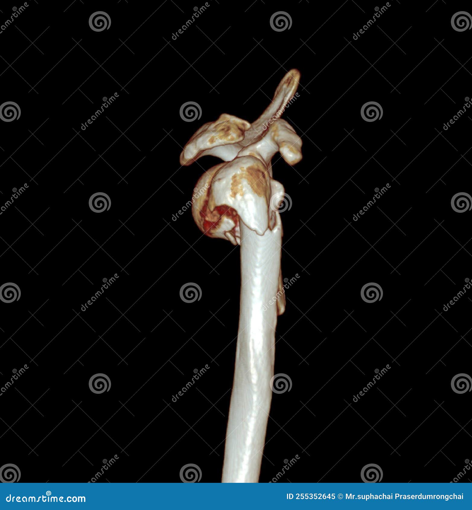 CT scan of shoulder joint stock illustration. Illustration of ache ...