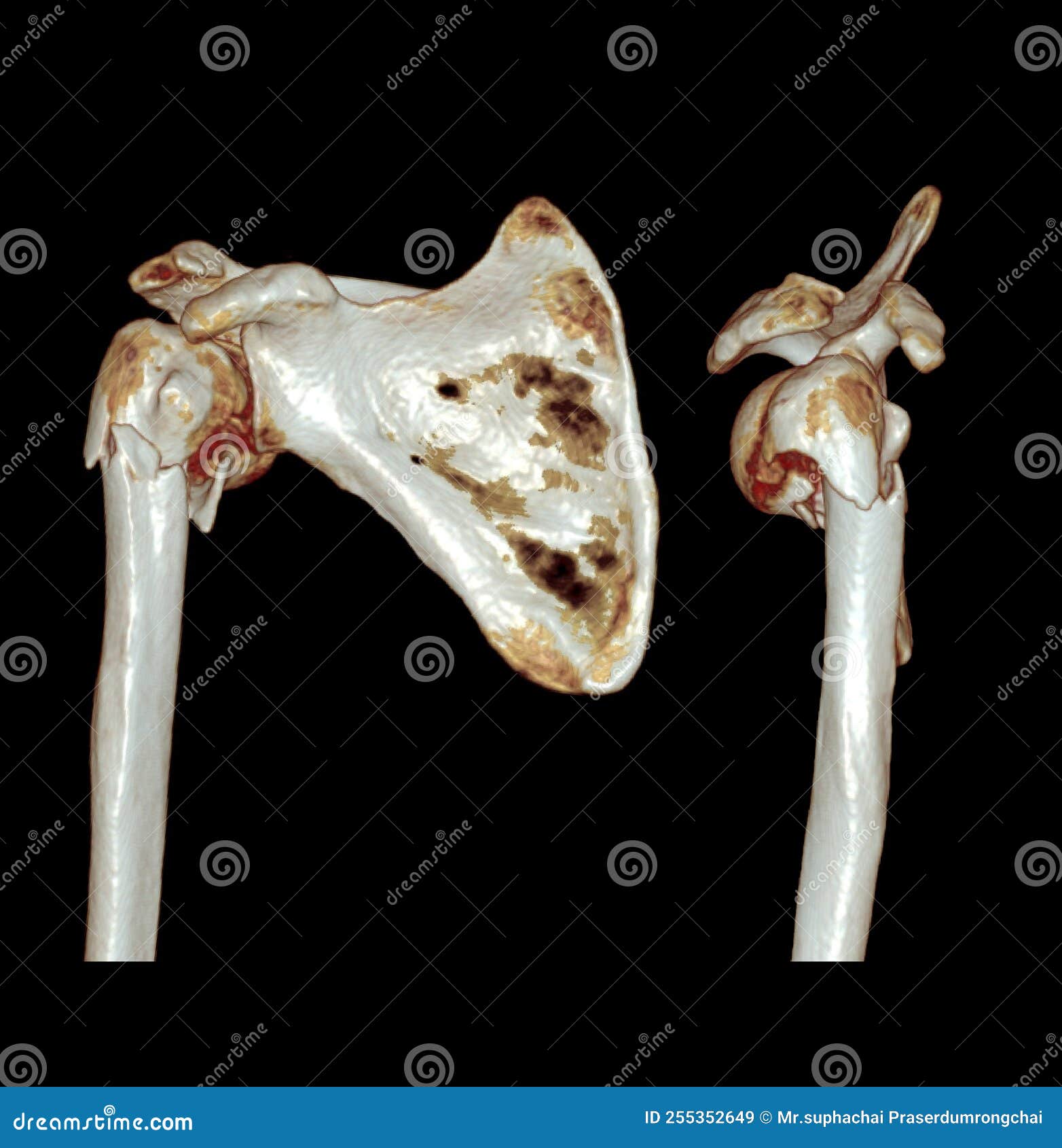 CT scan of shoulder joint stock illustration. Illustration of human ...