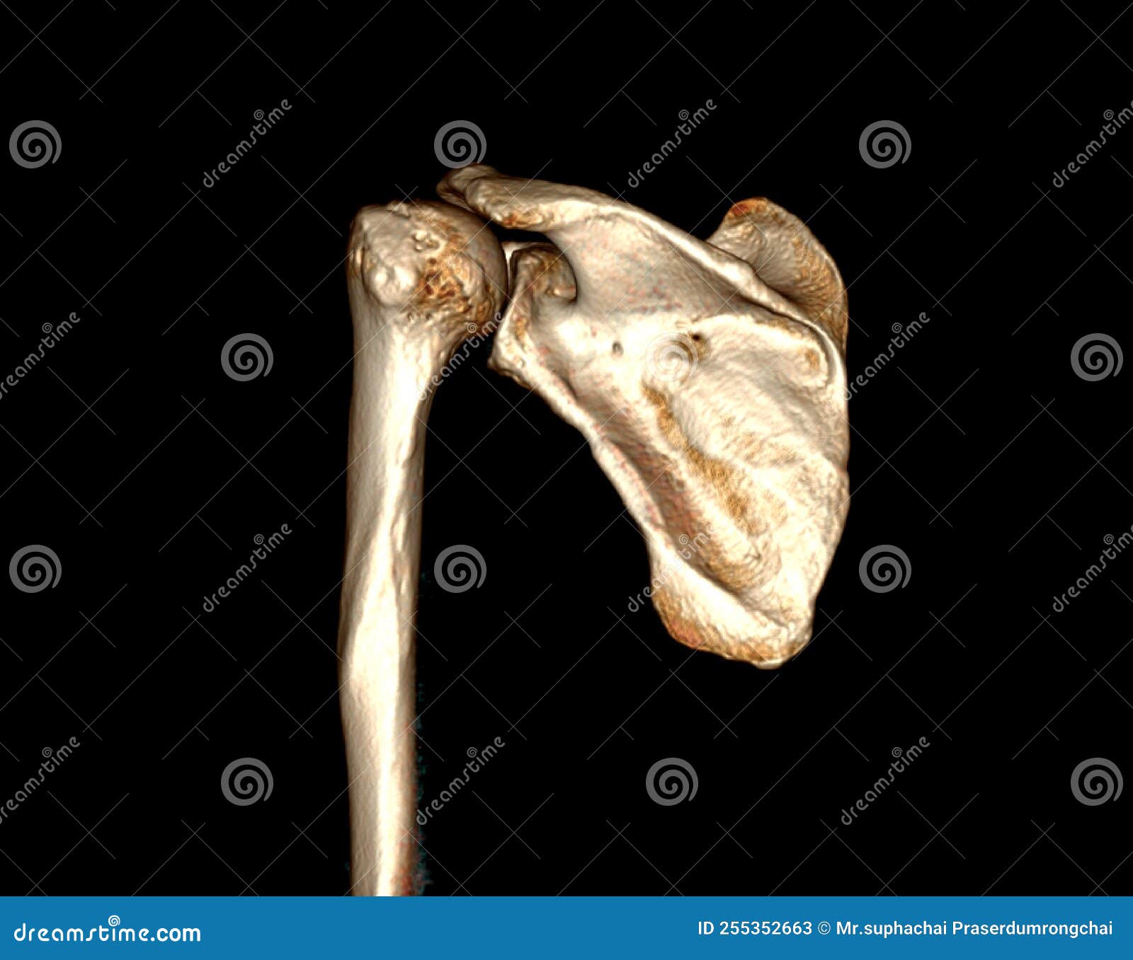 CT scan of shoulder joint stock illustration. Illustration of ...