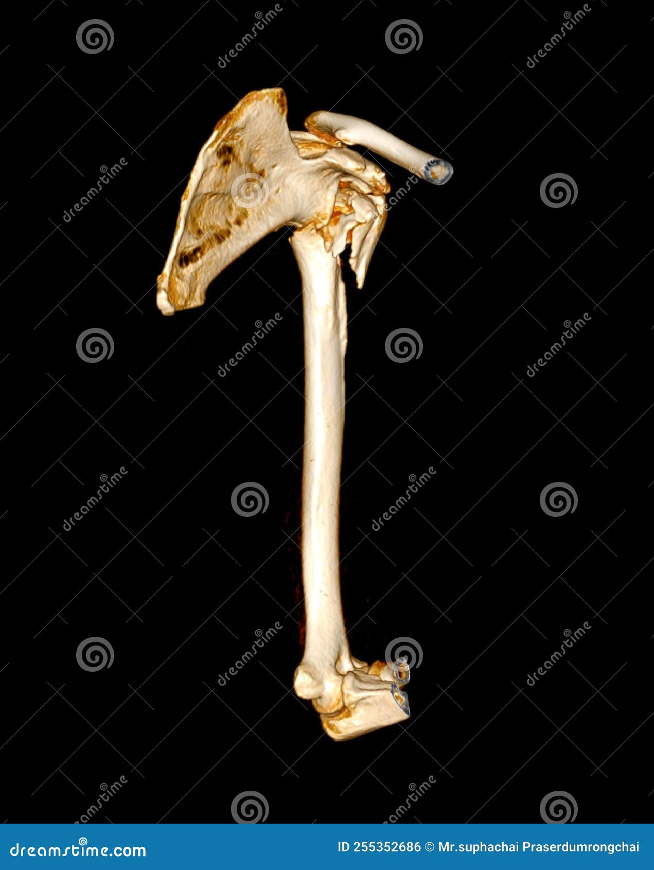 CT Scan of Shoulder Joint and Humerus Bone or Arm Stock Illustration ...