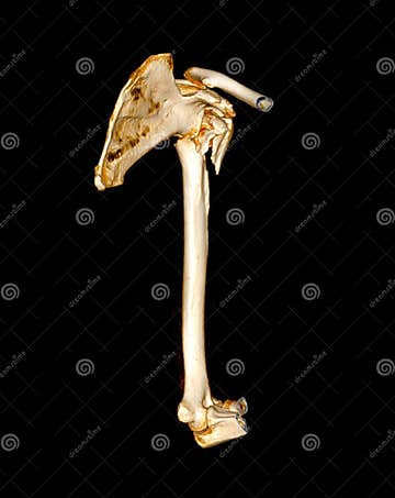 CT Scan of Shoulder Joint and Humerus Bone or Arm Stock Illustration ...