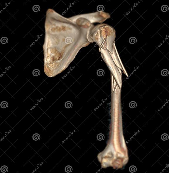 CT Scan of Shoulder Joint and Humerus Bone or Arm Stock Illustration ...