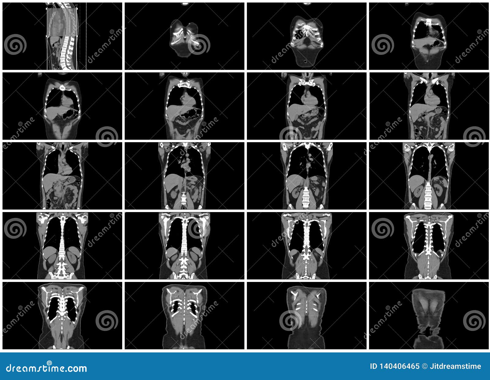 Ct Scan Step Set of Body Coronal View Stock Image - Image of digital ...