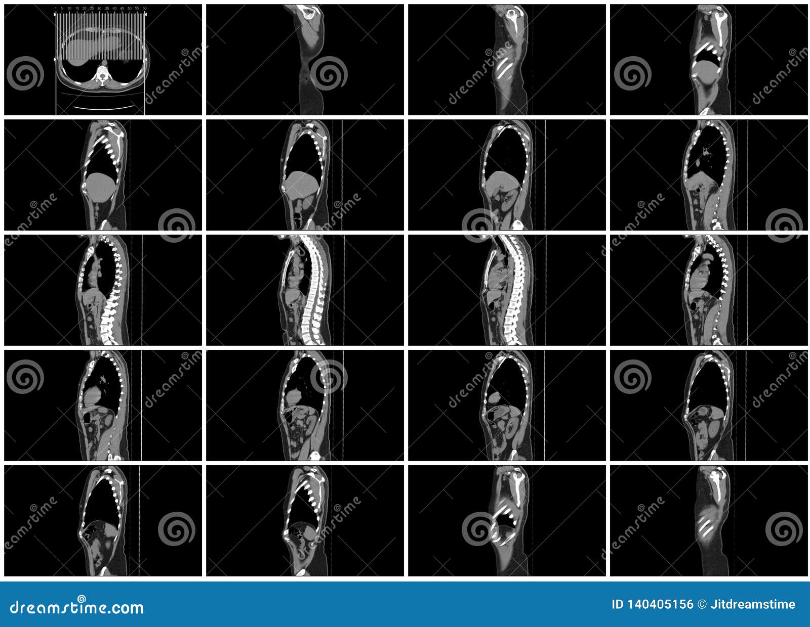 Ct Scan Step Set of Body Sagittal View Stock Photo - Image of analyses ...