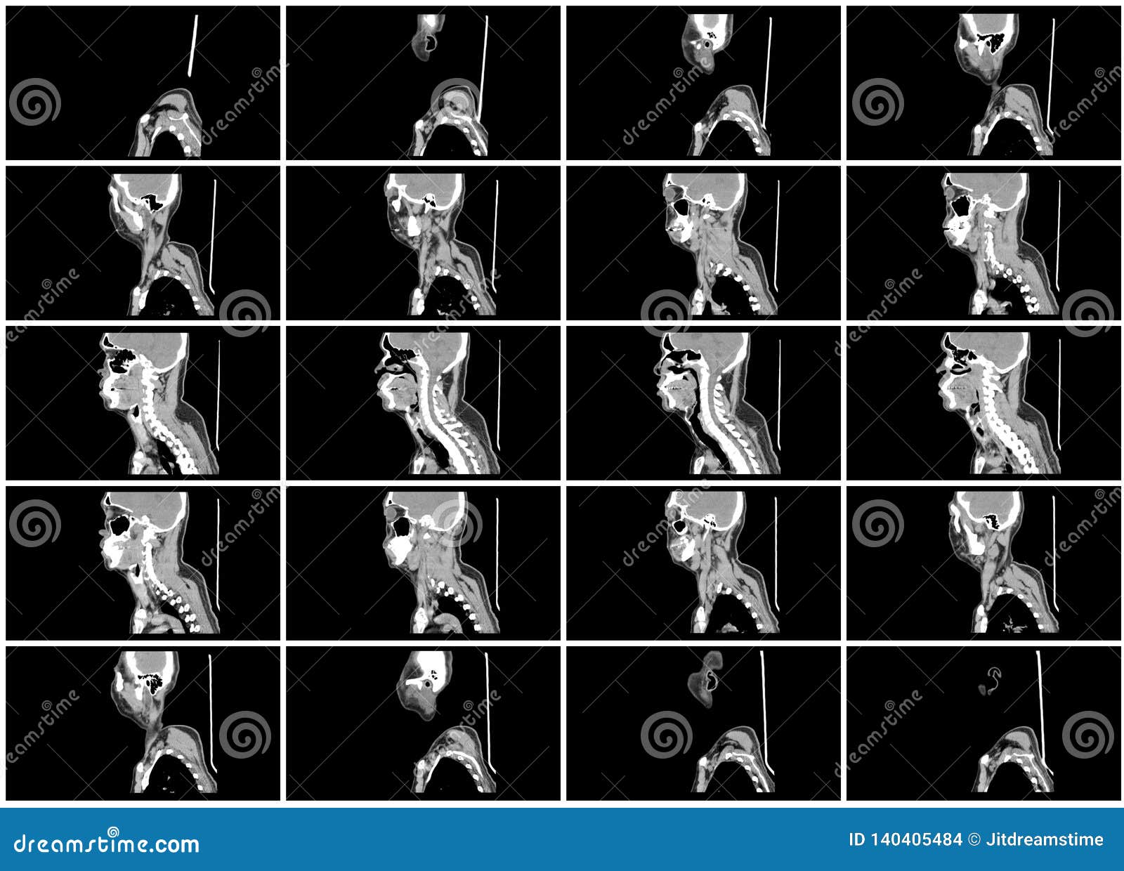 MRI Scan Sagittal View Lumbosacral Spine Has Straightening Lumbar ...