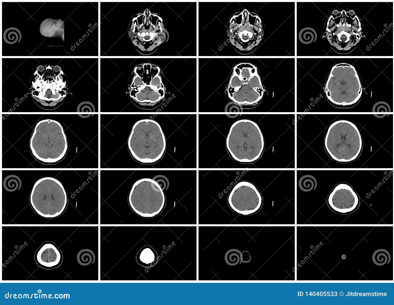 Ct Scan Step Set Of Body Lung Sagittal View Royalty Free Stock Image 140405098