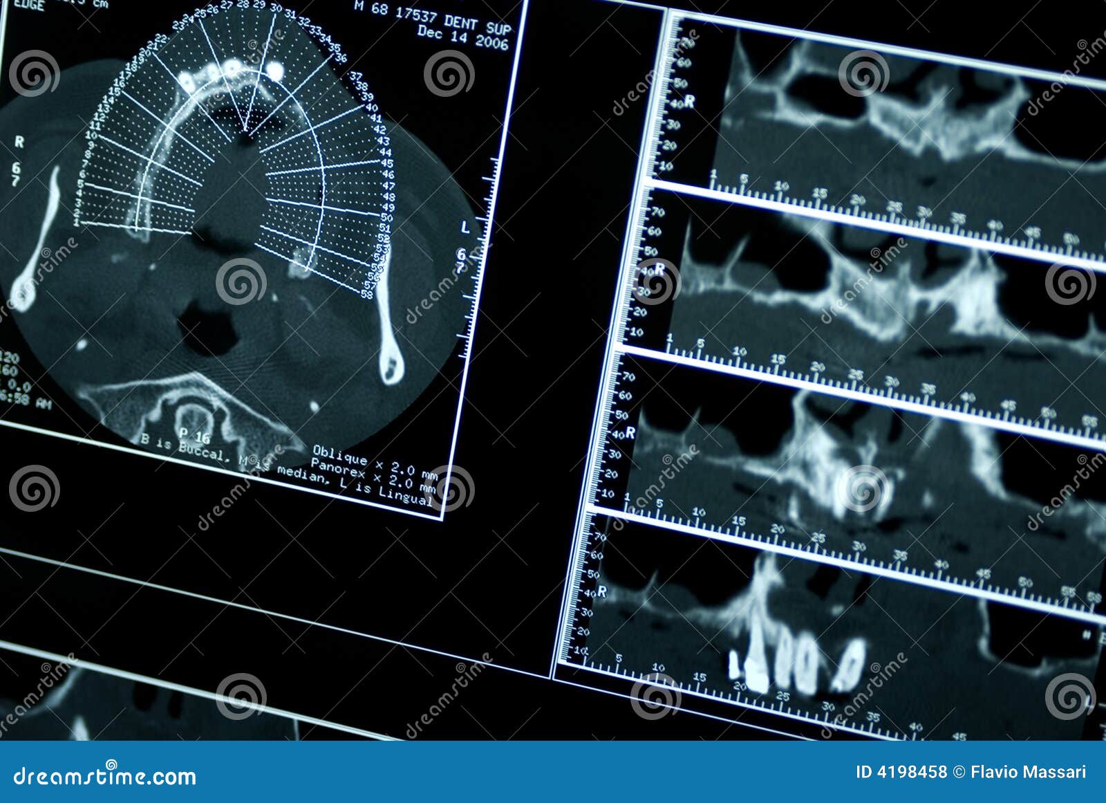 CT Scan Tomography Radiography of Mouth Stock Photo - Image of lamp ...