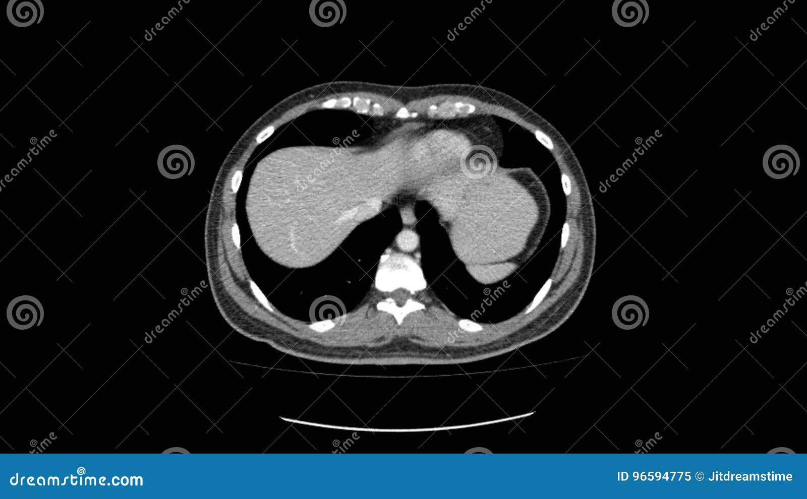 Ct Scan of Upper Abdomen Top View Stock Video - Video of medical ...