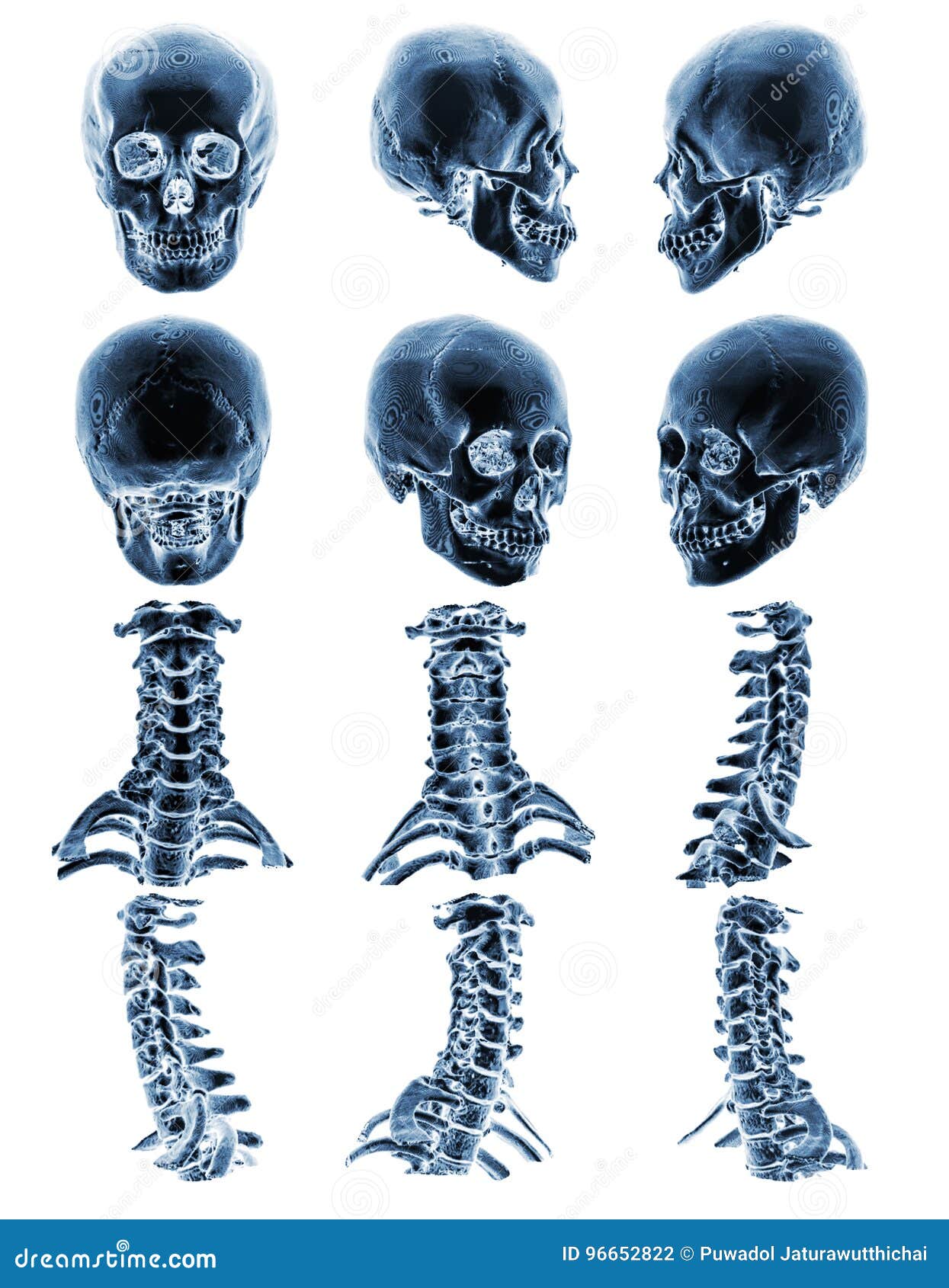 X-ray Normal Human Foot . Lateral View . Invert Color Style Royalty ...