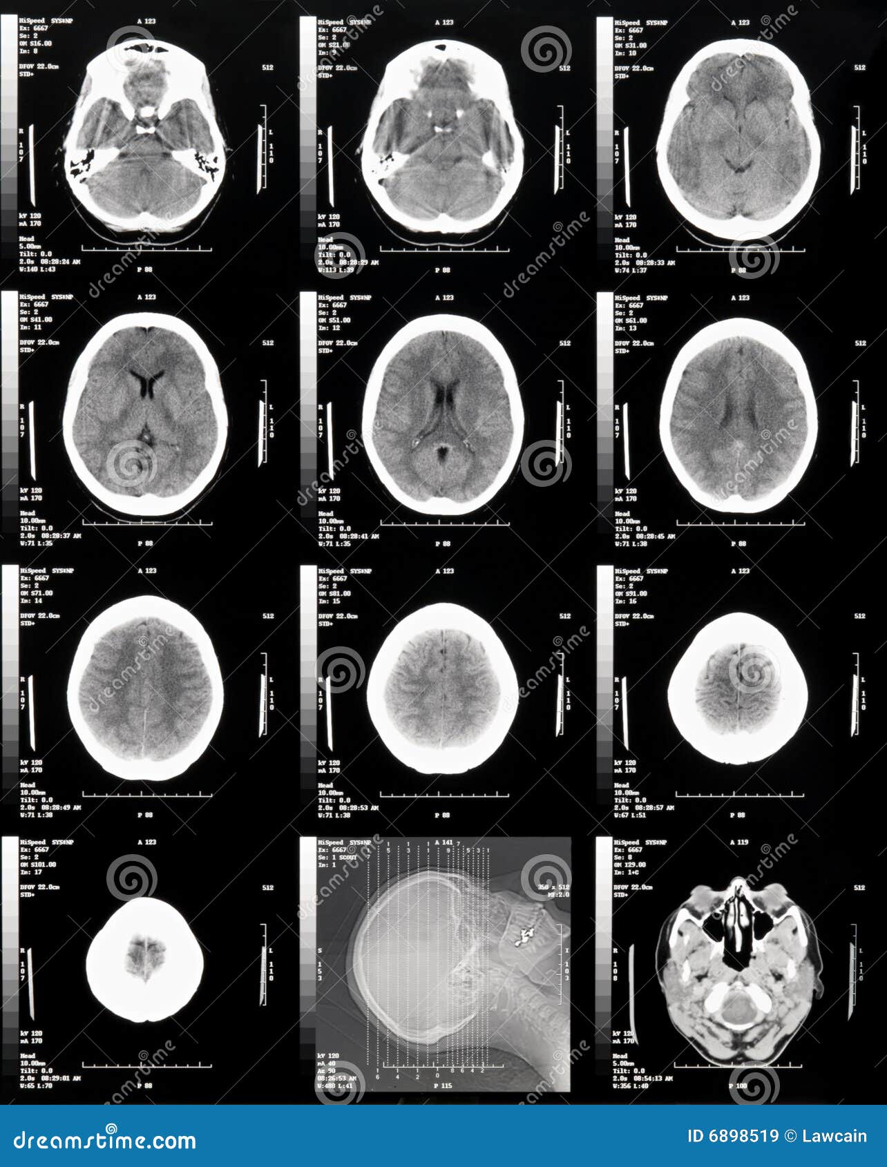 CT Van Hersenen Met Verkenner Stock Afbeelding - Image of gezondheid ...