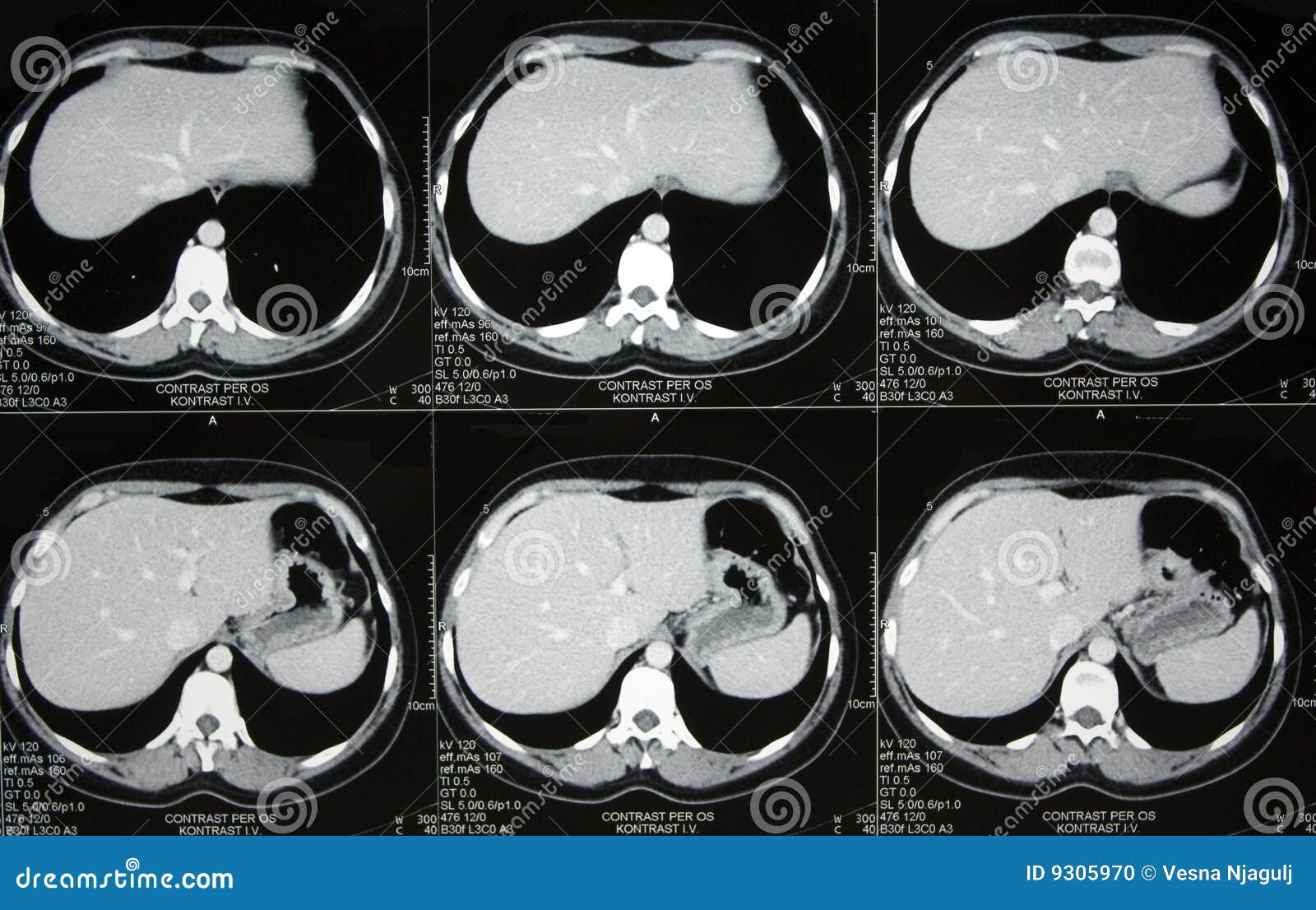 CT von Abdomen, Leber stockfoto. Bild von strahl, geduldig - 9305970