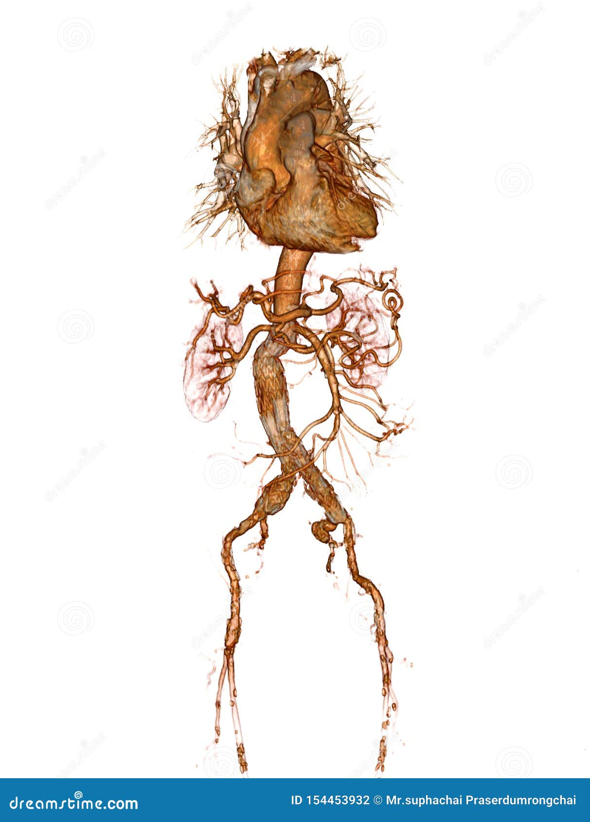 CTA Abdominal Aorta 3D Rendering Image Showing Aortic Dissection ...