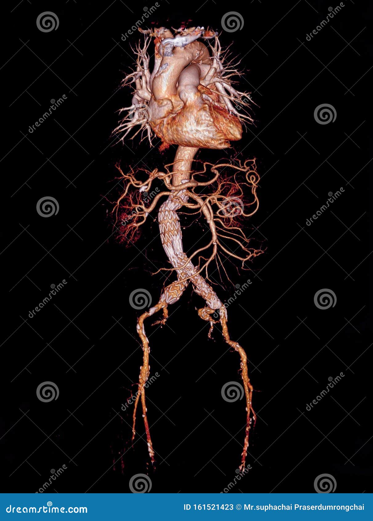 CTA Abdominal Aorta 3D Rendering Image On Transparent Skeletal Stock ...