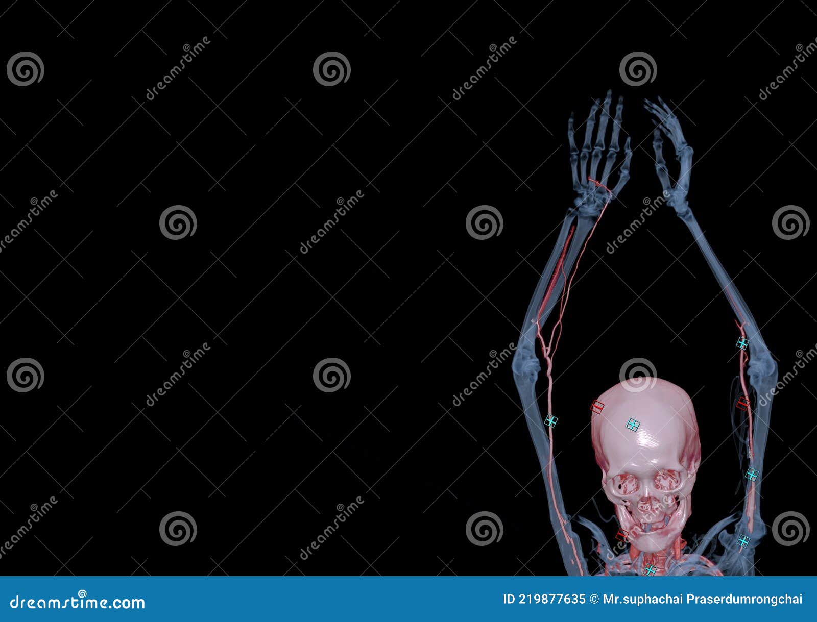 CTA Brachial Artery Or CT Scan Of Upper Extremity Or The Arm 3d ...