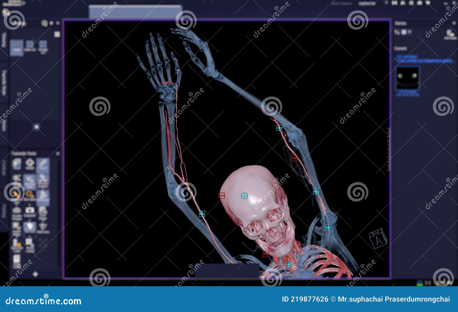 CTA Brachial Artery or CT Scan of Upper Extremity or the Arm 3d ...
