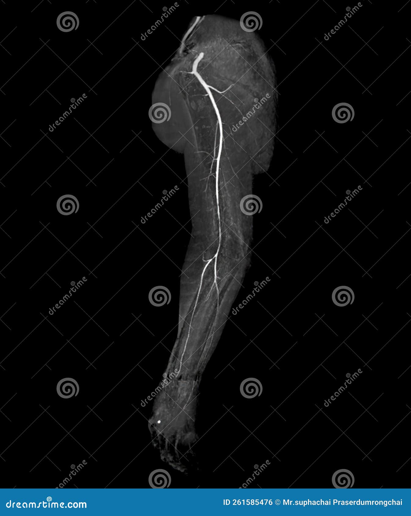 Cta Brachial Artery Or Ct Scan Of Upper Extremity 3d Rendering Image