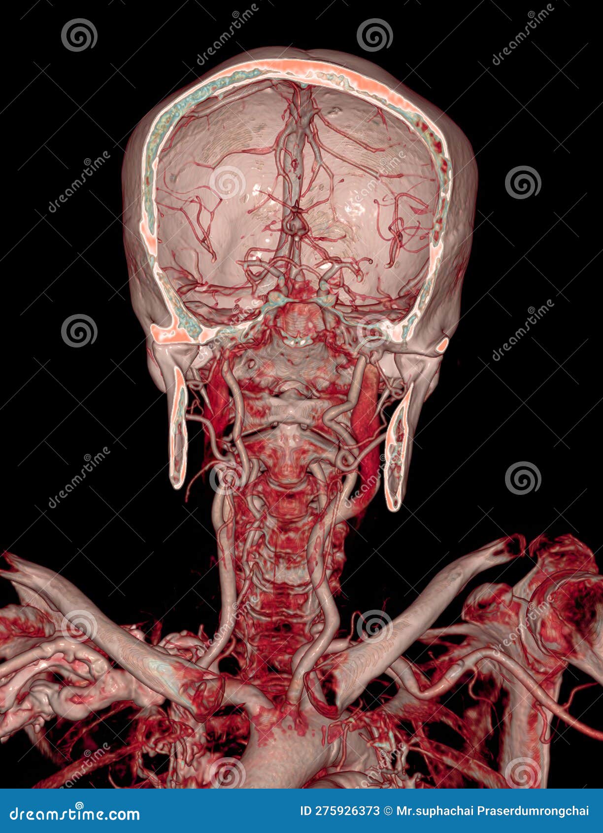 CTA Brain and Carotid Artery or CT Angiography of the Brain 3D ...